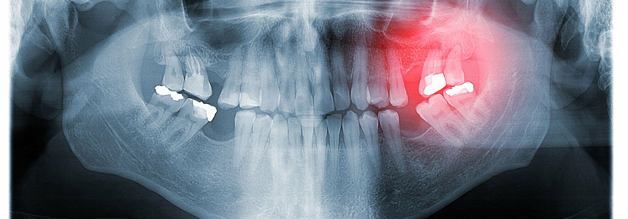 Periodontitis - Bradford Family Dentistry