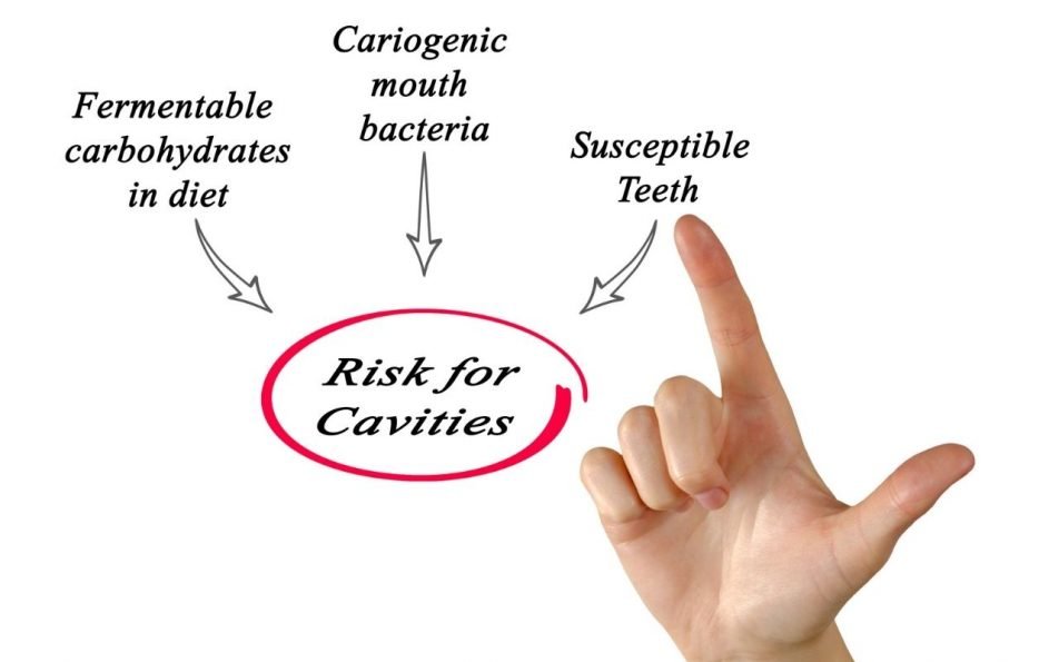 Cavities Are Caused By Infectious Bacteria - Bradford Family Dentistry