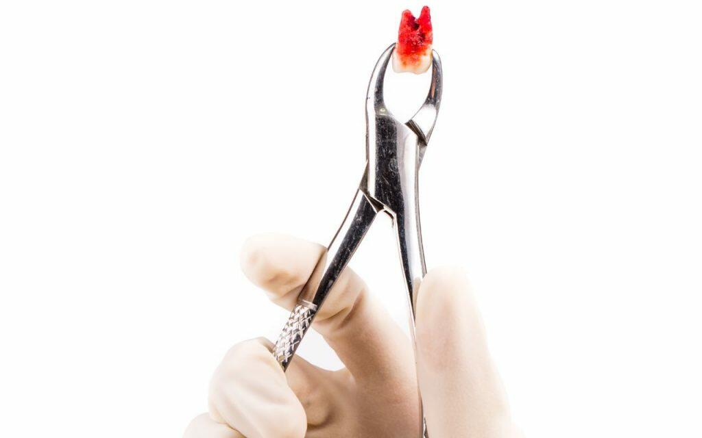 What To Do About A Knocked-Out Tooth - Bradford Family Dentistry