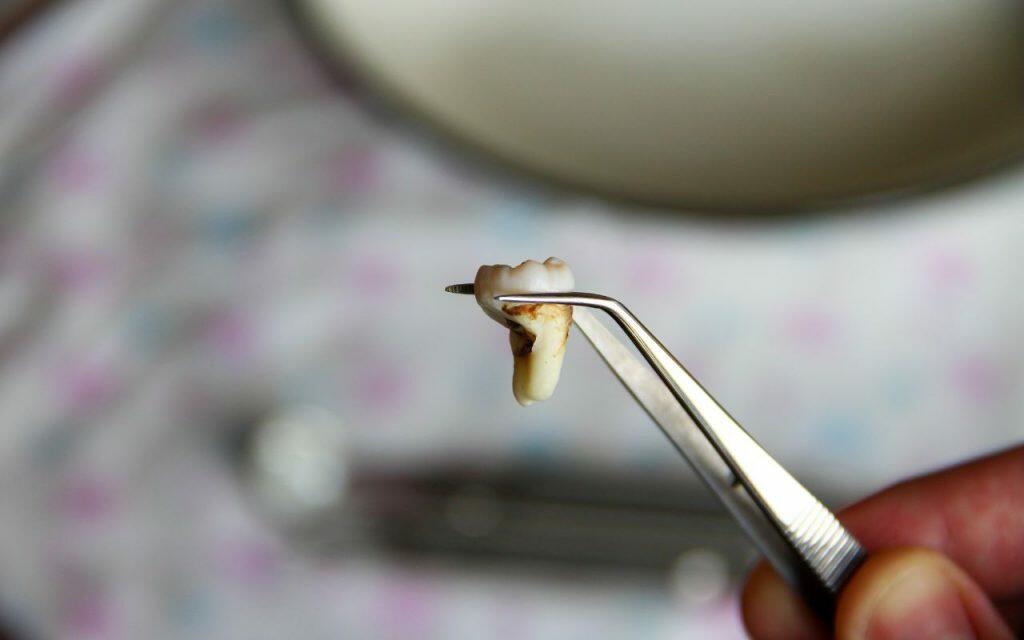 What To Do About A Knocked-Out Tooth - Bradford Family Dentistry