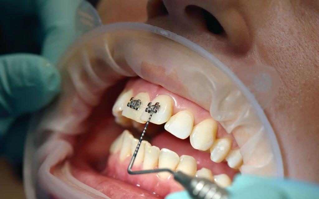 What Does A Typical Orthodontic Visit Look Like? - Bradford Family ...