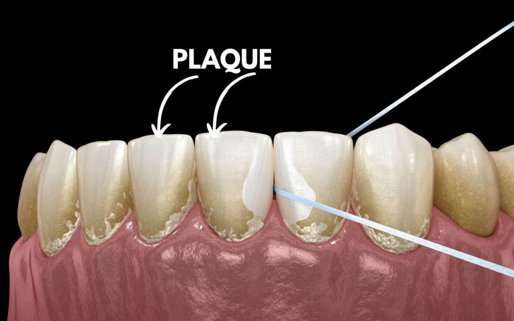 Plaque vs Tartar: What’s The Difference? - Bradford Family Dentistry