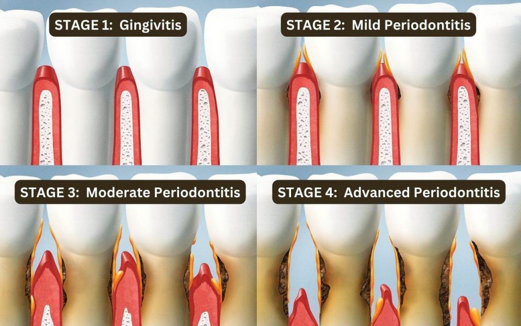 Do You Have Gum Disease And Not Even Know It? - Bradford Family Dentistry