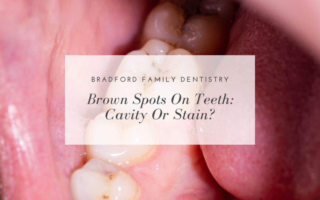 brown spots on teeth - cavity or stain - Bradford Family Dentistry